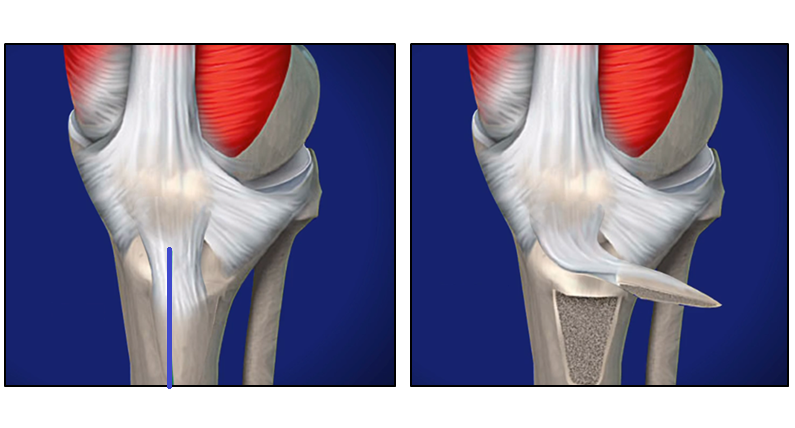 médialisation de la tubérosité tibiale antérieure - Dr Arnaud FELDEN