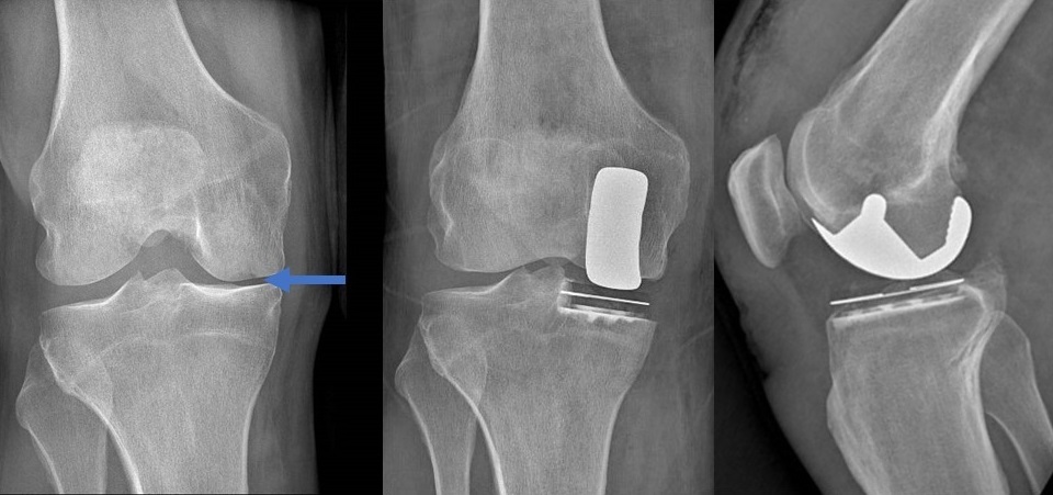 Prothèse de genou Réunion - 974 - PUC – arthrose genou – Dr FELDEN